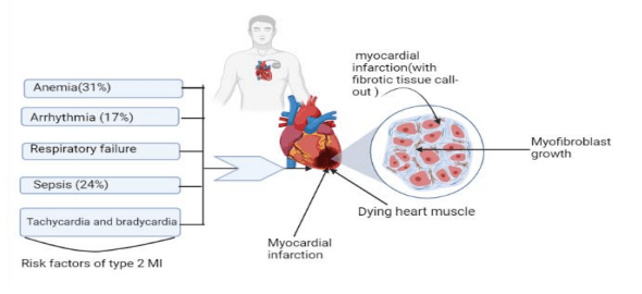 Novel Potential Targets of Type 2 Myocardial Infarction | IJPPR